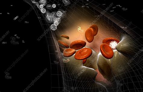 Atheromatous Plaque Stock Image F Science Photo Library