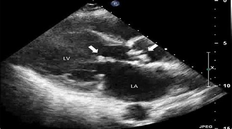 Streptococcus Mutans Induced Infective Endocarditis Associat Jcr