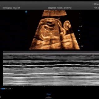 M Mode Echocardiography Showed Decreased And Flat Left Ventricular Wall