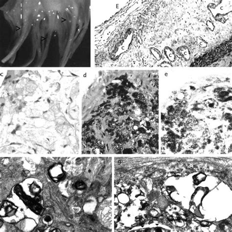 Surgical And Post Mortem Specimens A Lesions On Chordae Tendineae