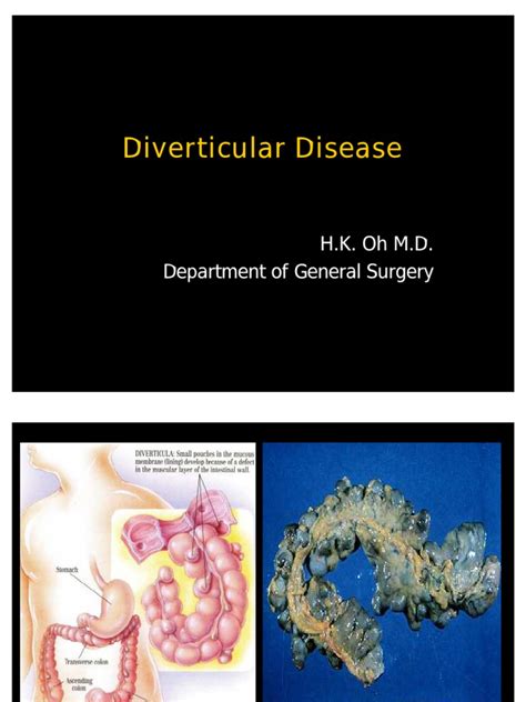 Diverticulitis Epidemiology Medical Specialties