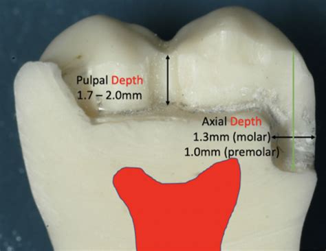 Class Ii Cavity Design Flashcards Quizlet