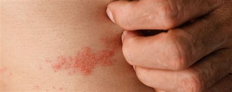 Fungal Vs Bacterial Skin Infections What To Know Schwabe India