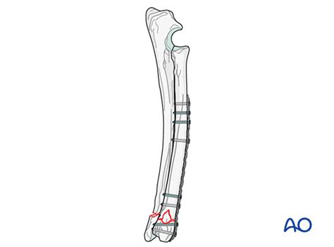Bridging Plate Fixation For Multifragmentary Extraarticular Fracture Of The Distal Radius
