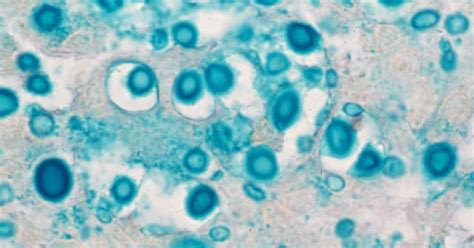 Histopatología Criptococosis