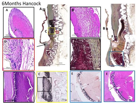 Renewing The Promise Of Bioabsorbable Implants • Healthcare In