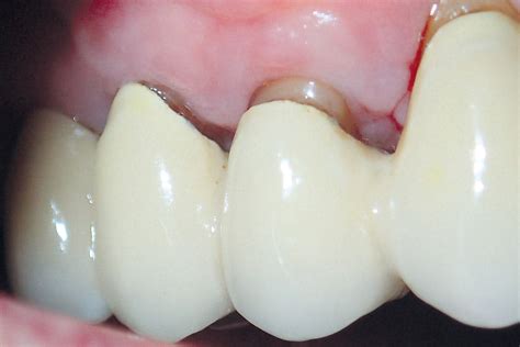 Gtr For The Treatment Of A Deep Three Dimensional Intrabony Defect