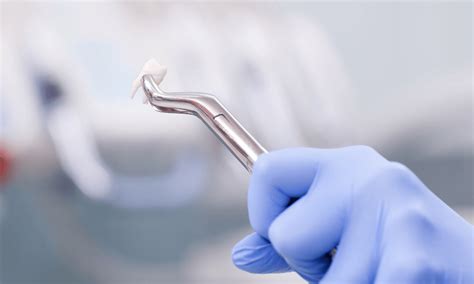 Routine Tooth Extraction Dentist In Edgewater