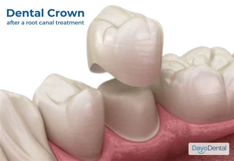Root Canal Procedure After Crown At Fernande Frank Blog
