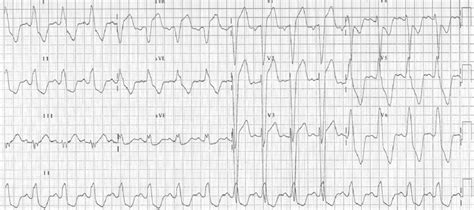 Initial Electrocardiogram Revealed Complete Left Bundle Branch Block Download Scientific Diagram