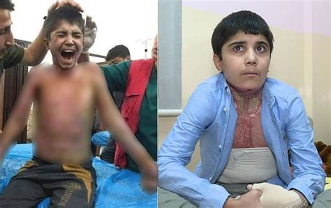 محمد يستكمل علاجه من الحروق في فرنسا عائداً رووداونيت