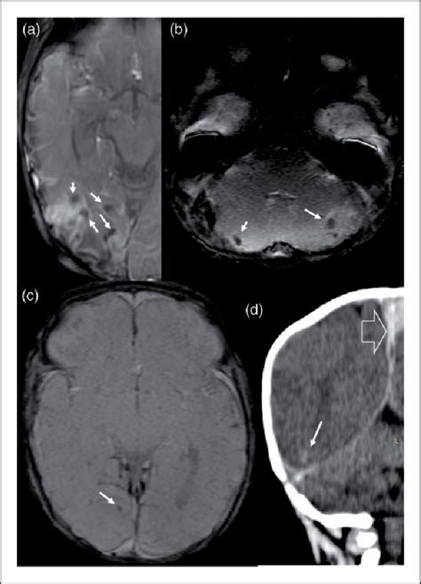 A Case 1 Gradient Echo T2 Susceptibility Weighted Angiography Swan