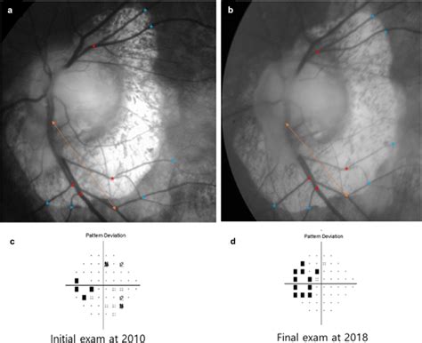 A Representative Case With Enlargement Of β Peripapillary Atrophy