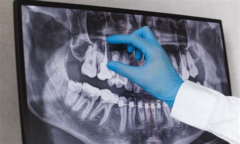 Comprehensive Guide To Root Canal X Rays For Radiologists By Hsin Film Medium