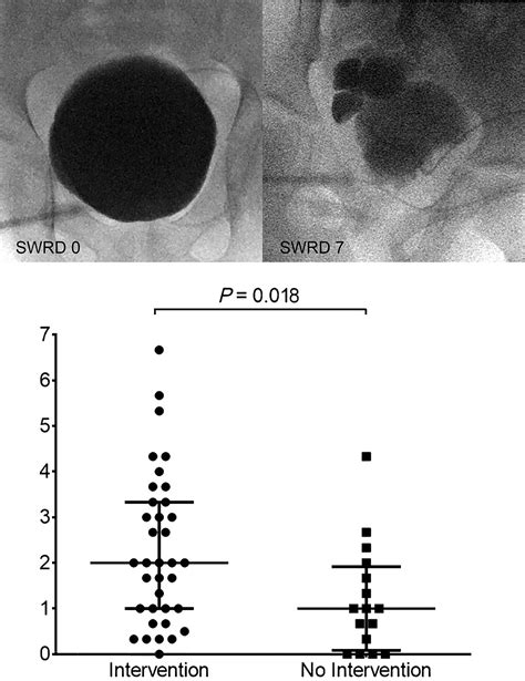 Cystometrogram Appearance In Puv Is Reliably Quantified By The Shape