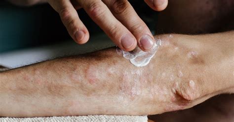 What Are Related Medical Conditions Of Psoriasis Your FAQs