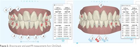 Figure 1 From Quantitative Assessment Of Interproximal Tooth Reduction