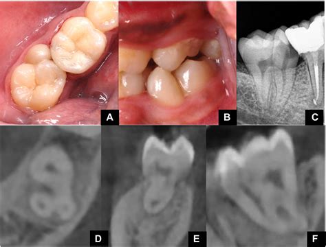 Nonsurgical Endodontic Management Of Molar Paramolar Fusion In A