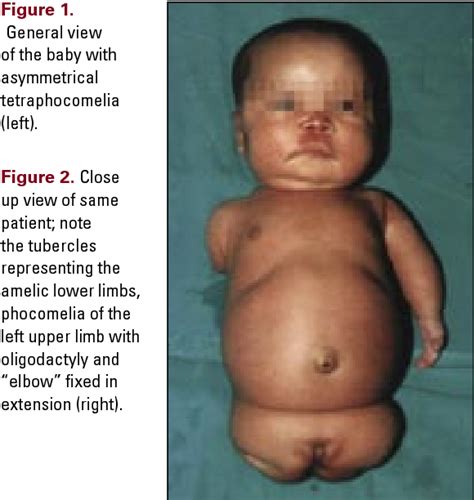 Human Echolocation Video Etc Healing Tao USA