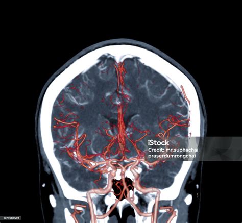 Ct 혈관 뇌 코로나 보기 3d 렌더링 이미지 쇼 혈관의 인간의 머리에서 Cat 스캔에 대한 스톡 사진 및 기타 이미지 Cat 스캔 Cat 스캔 기계 Mri 스캔