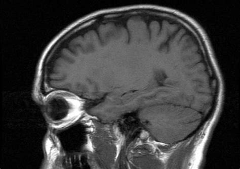 Experts Develop Epilepsy Warning Device