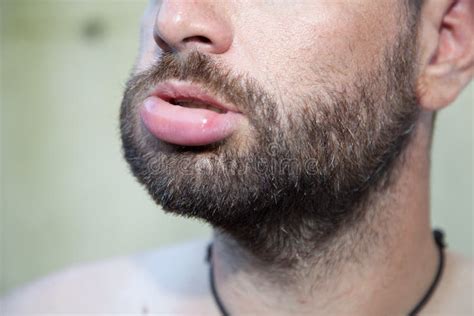 Spongebob Kevin Swollen Lips
