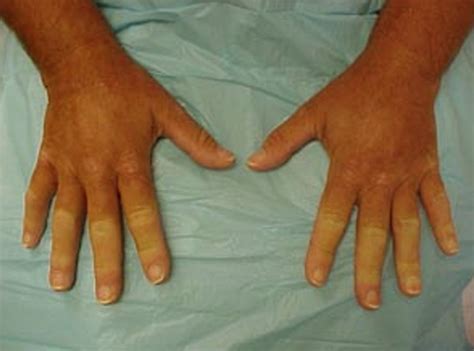 Scleroderma Pictures Treatment Prognosis Causes Symptoms