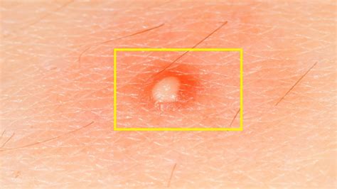 How To Get Rid Of A Boil On Groin Area Youtube