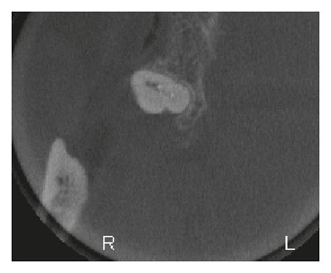 Treatment Sequence Of Tooth 18 A Preoperative Radiograph B