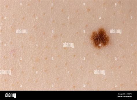 Benign Nevus Vs Melanoma