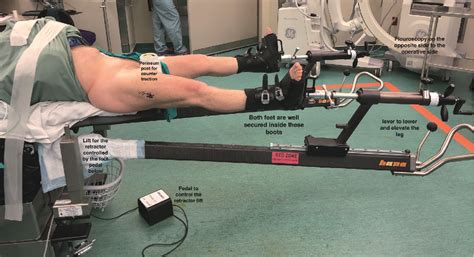 Figure 1 From The Direct Anterior Approach To The Hip For Total Hip