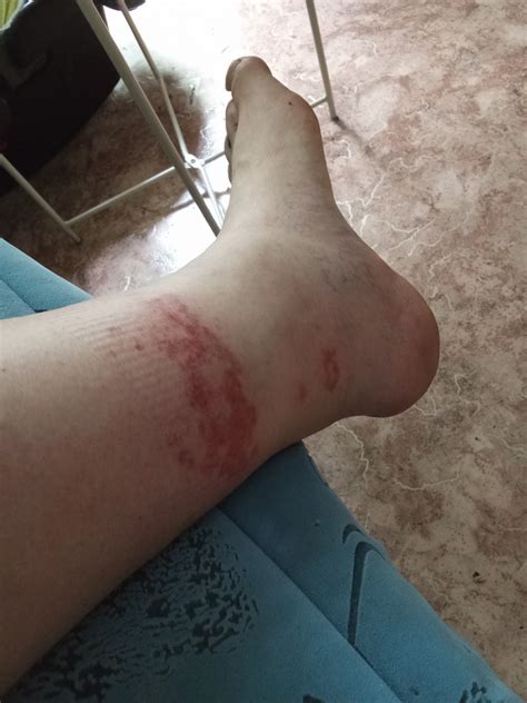 Появилось красное большое пятно на ноге Левая нога опухла Чуть ниже Medaboutme