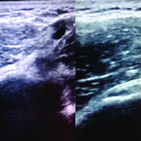 In Ultrasound There Were No Tendon Fibers In The Right Shoulder