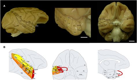 Superior Temporal Gyrus