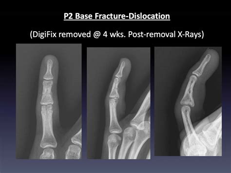 Case 3 14 Yo P2 Base Fracture Dislocation Virak Orthopedics