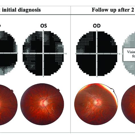 Progression Of Perimetric And Fundoscopic Findings In Patient A An