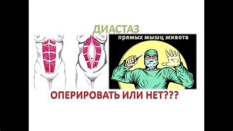 Диастаз прямых мышц живота нужно ли оперировать Виды операций Youtube