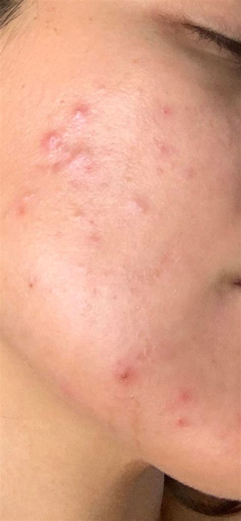 Before And After 8 Weeks On Differin With Super Dry Skin R