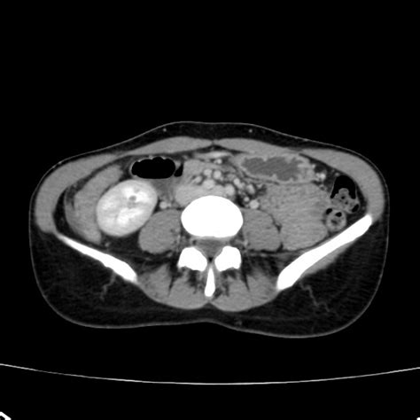 Appendicitis Ct Radiopaedia Treatment May Include Intravenous