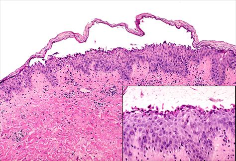 Acantholysis Histology