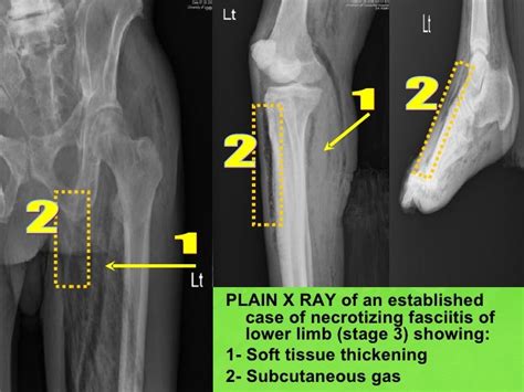Necrotizing Fasciitis