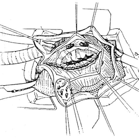 Conversion To Standard Median Sternotomy Incision From Paramedian