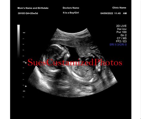 20 Weeks Ultrasound Girl 20 Weeks Ultrasound Girl
