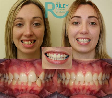 Invisalign Before And After Crowding