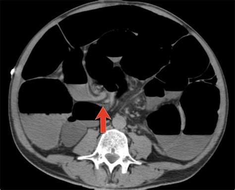 The Radiology Assistant Closed Loop Obstruction In Small Bowel Obstruction