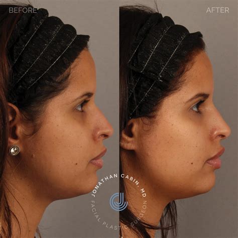 Non Surgical Rhinoplasty Before And Afters Dr Jonathan Cabin