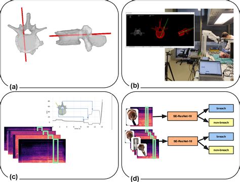 Figure 1 From Automatic Breach Detection During Spine Pedicle Drilling Based On Vibroacoustic