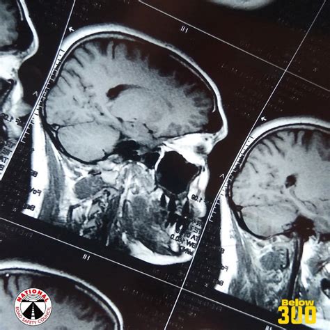 Опухоль головного черепа