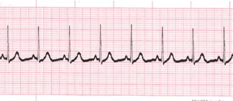 Telemetry Flashcards Quizlet