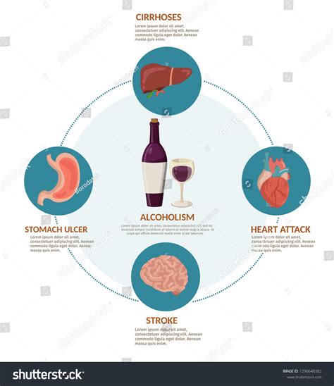 Diseases From Alcoholism Medical Infographics Royalty Free Stock Vector 1296648382 Avopix